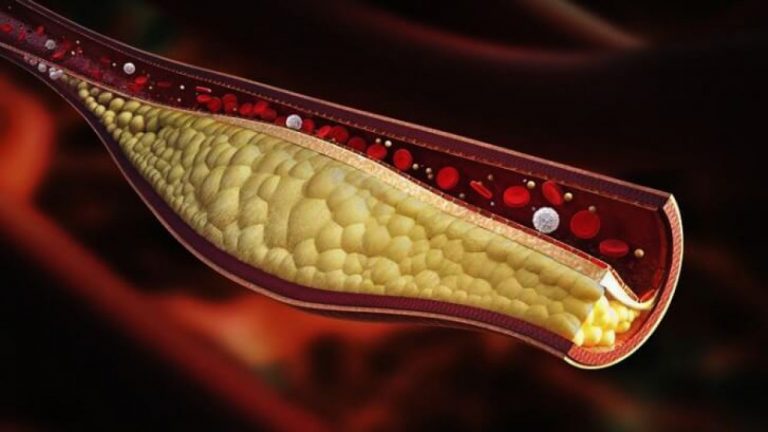 Penyebab, Gejala dan Cara Mengobati Kista Ateroma – PT Tiga Puspa